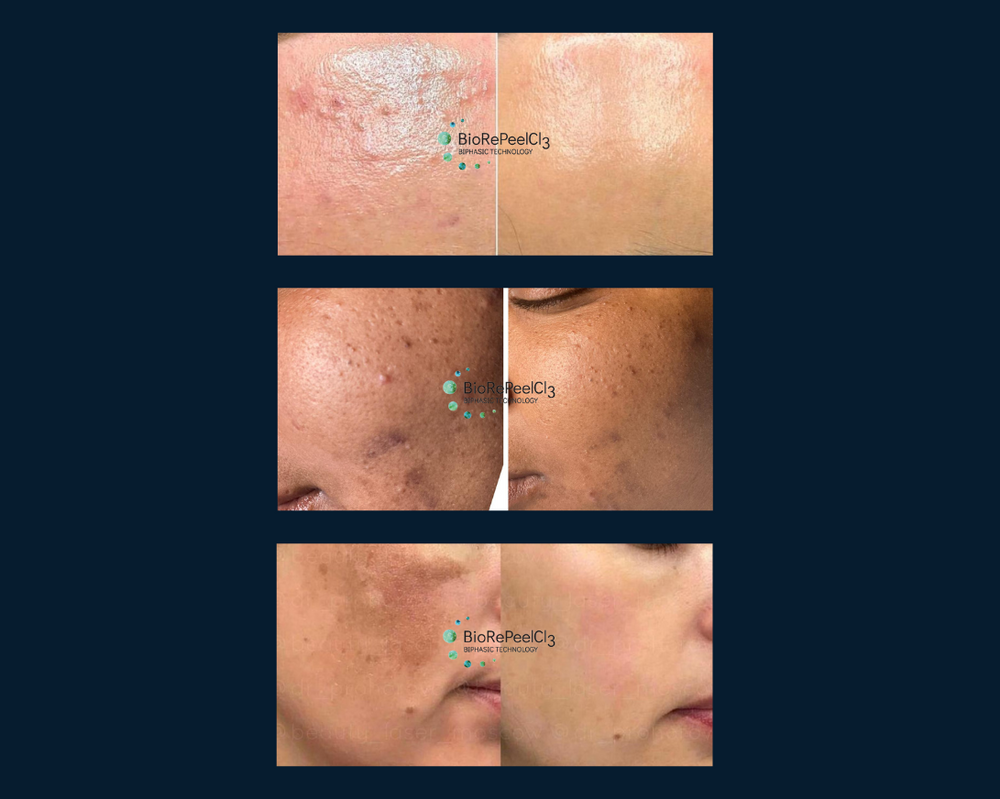 BioRePeelCl3® | Chemical Peel Treatment NYC – Aesthetic Allure
