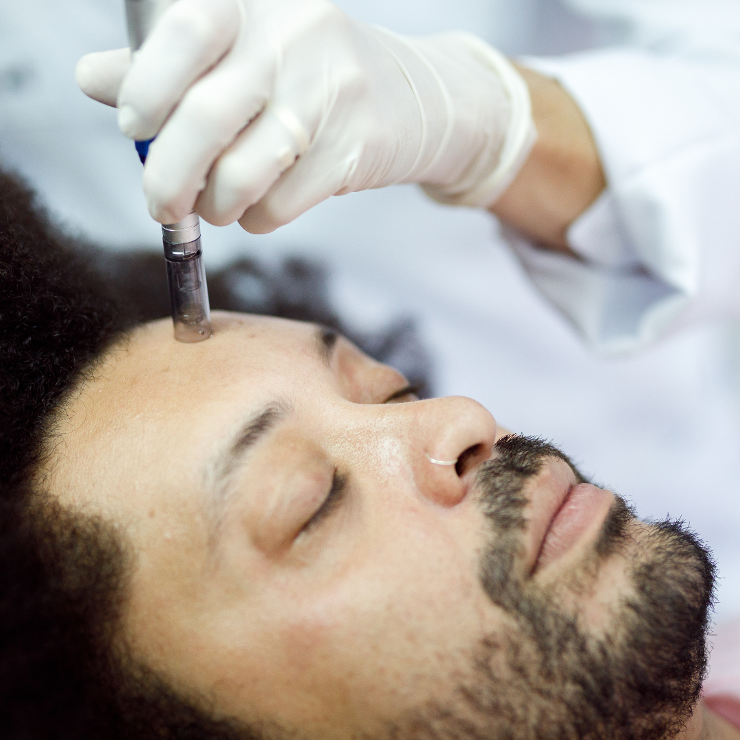 Microneedling Facial Treatment | Brooklyn – Aesthetic Allure